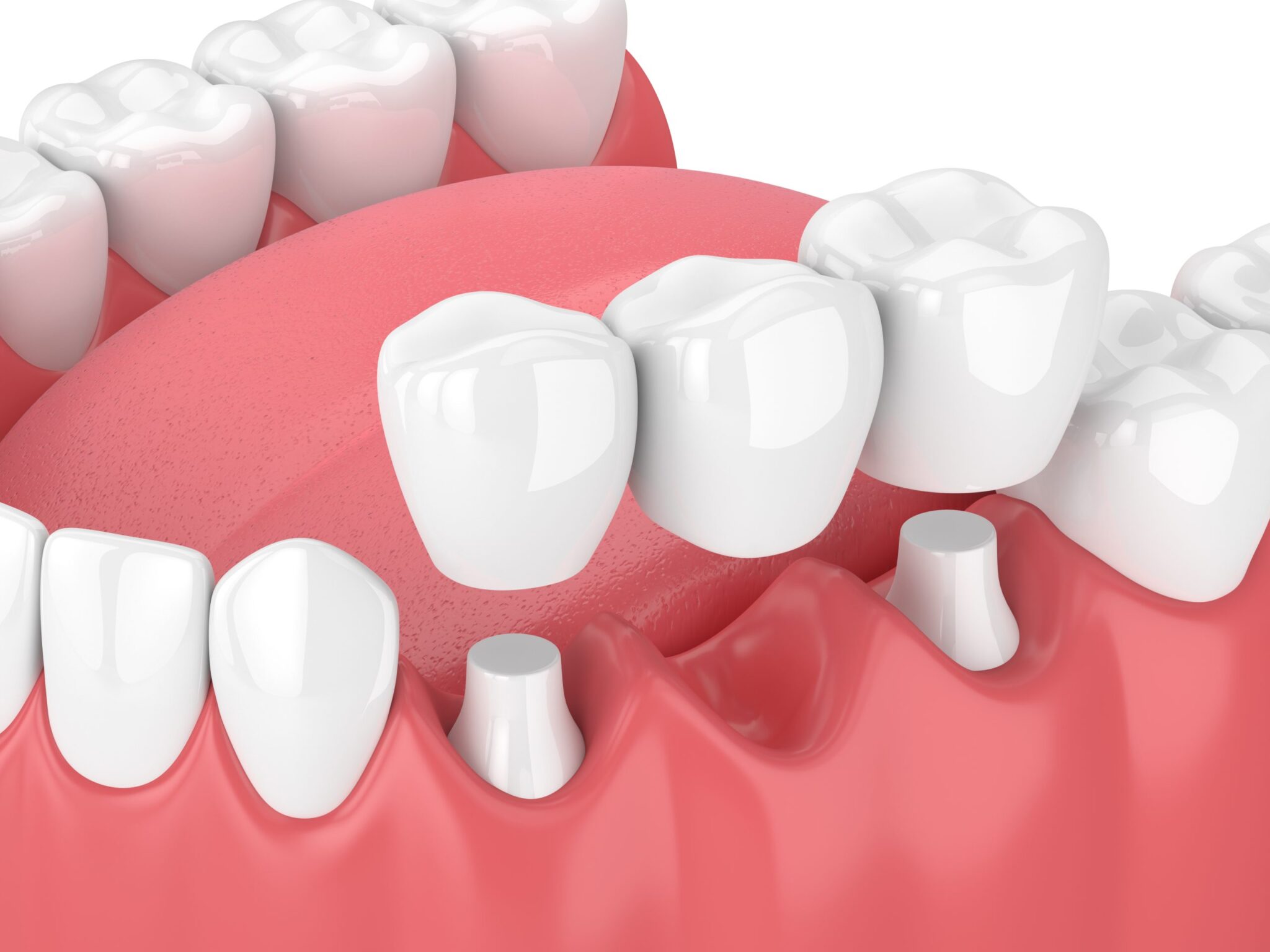 Expert Dental Bridge Solutions | Concord Dental